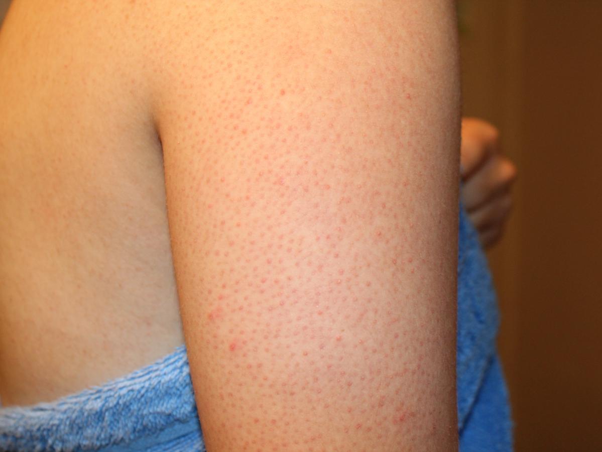 Here s The Reason You Are Getting Red Bumps On Your Arms Nova 969 here-s-the-reason-you-are-getting-red-bumps-on-your-arms-nova-969