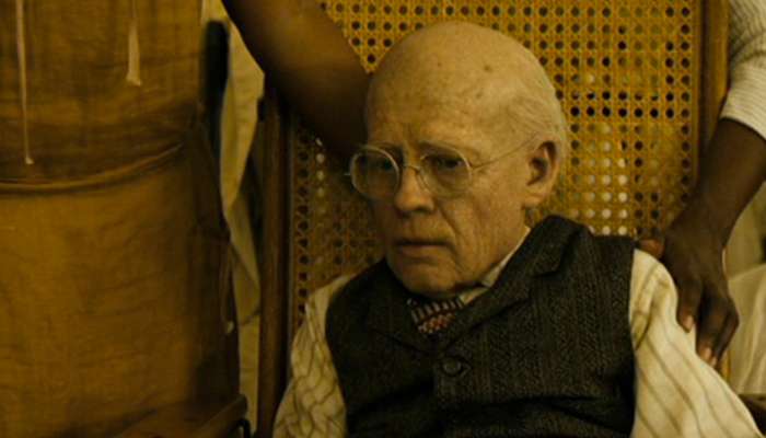 The tragic tale of the real life kids with “Benjamin Button’s” disease ...